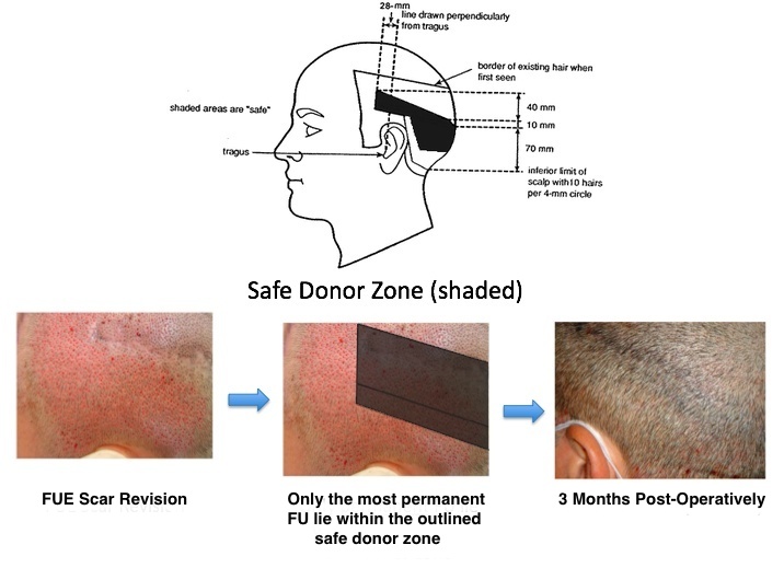Follicular Unit Extraction (FUE) in NYC | FUT New York - Dr. Carlos K ...